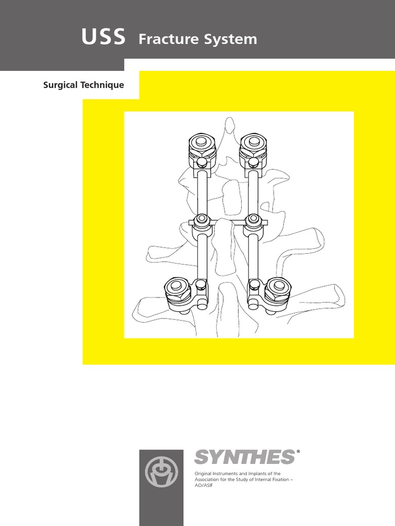 USS Fracture System Surgical Technique | PDF | Vertebra | Vertebral Column