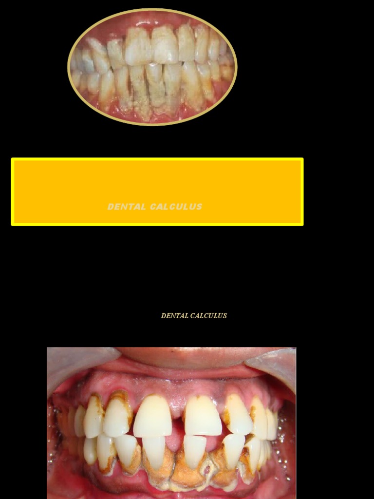 Classification of Dental Calculus | PDF | Periodontology | Dentistry