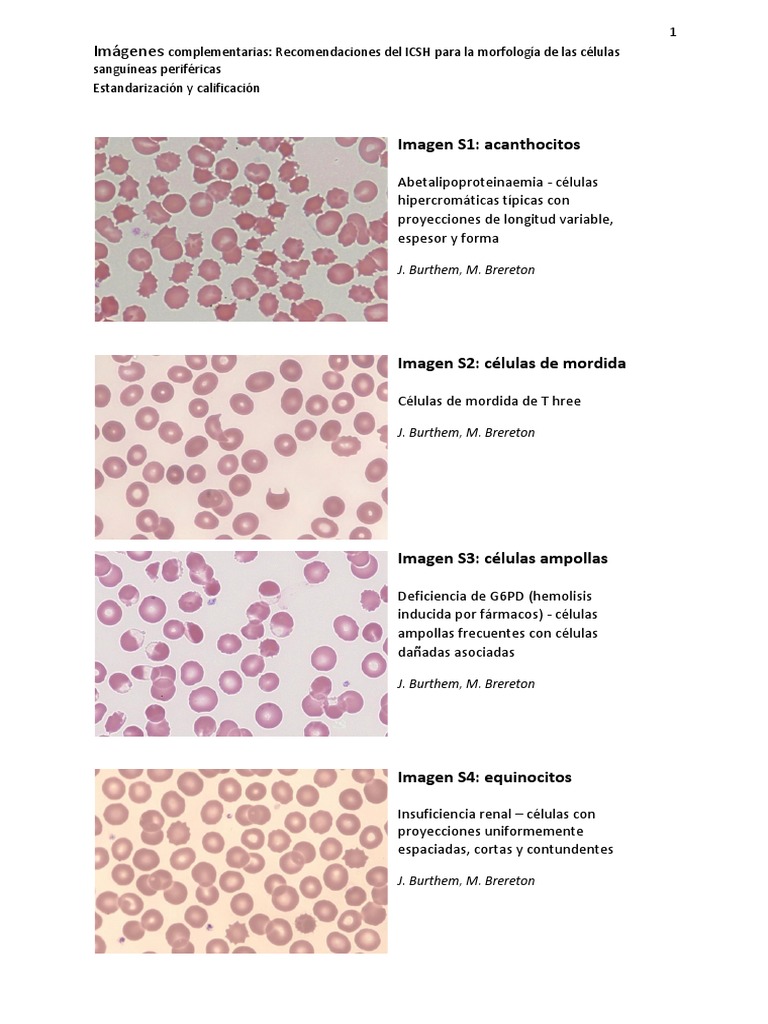 Guia ISCH | PDF | Leucemia | Plaqueta