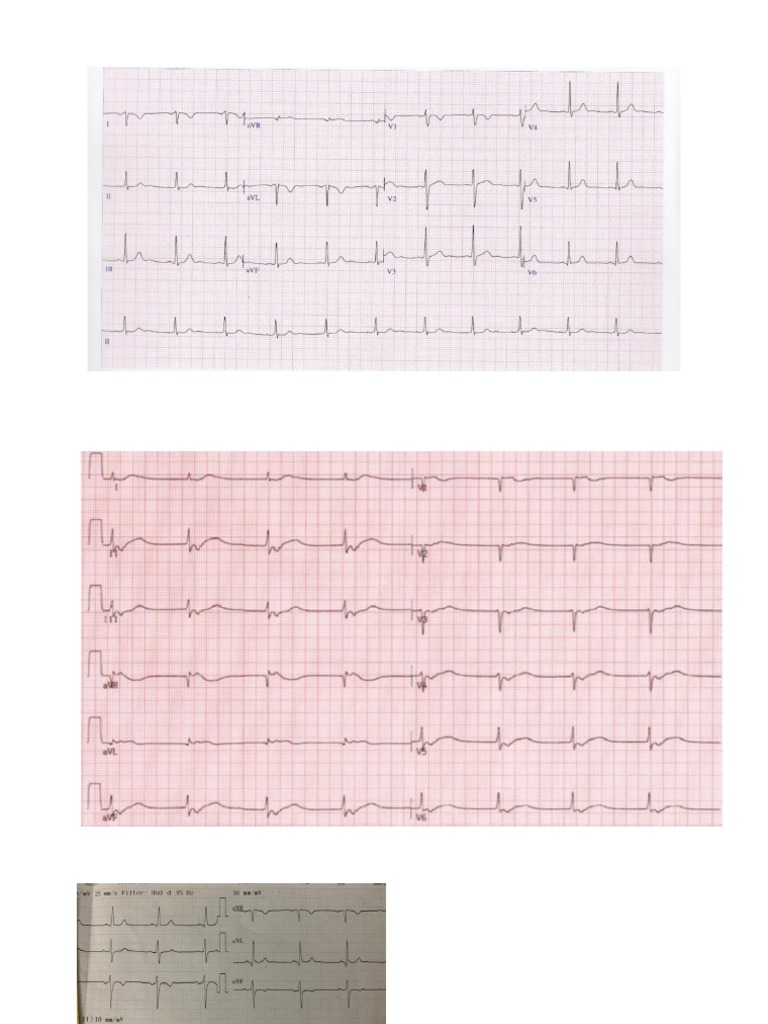 Ekg Ejemplos | PDF