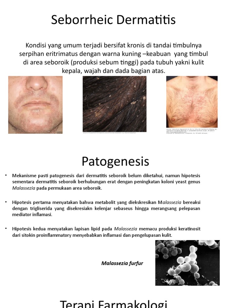 Dermatitis Seboroik | PDF | Kesehatan Holistik