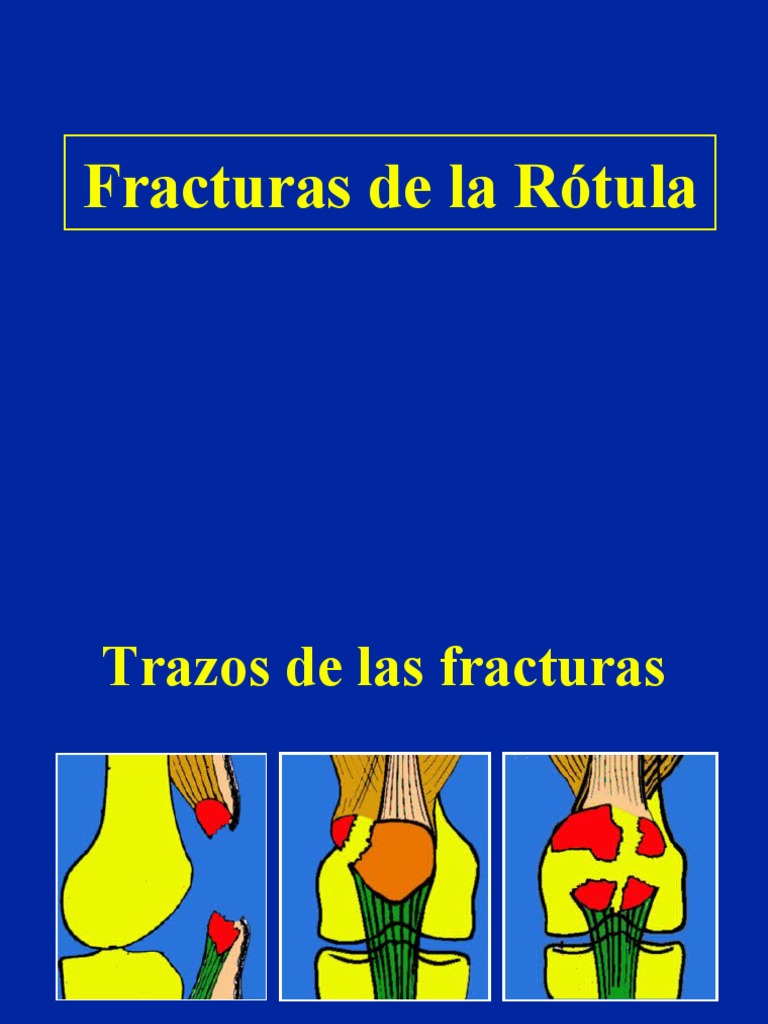 04 - Fracturas de La Rotula | PDF | Rodilla | Sistema musculoesquelético