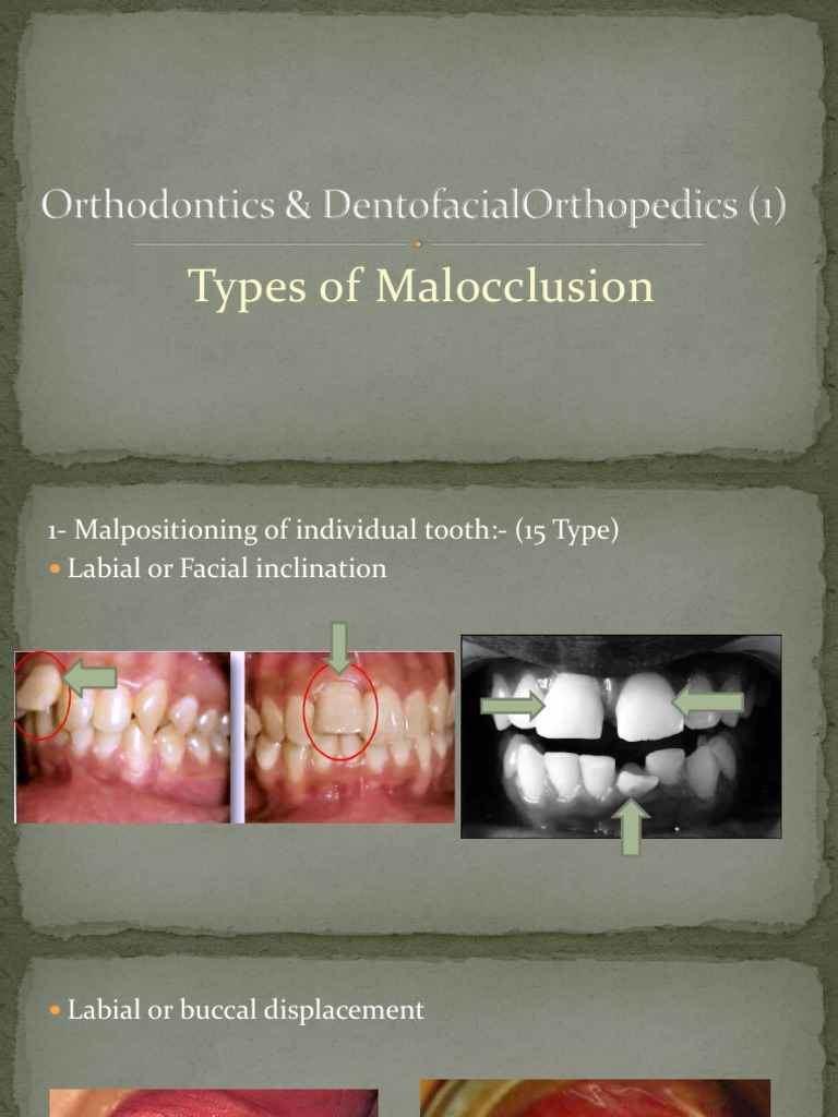 Types of Malocclusion | PDF | Foreign Language Studies