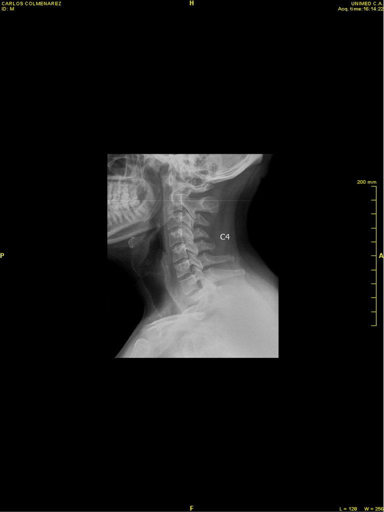 Cervical LAT | PDF