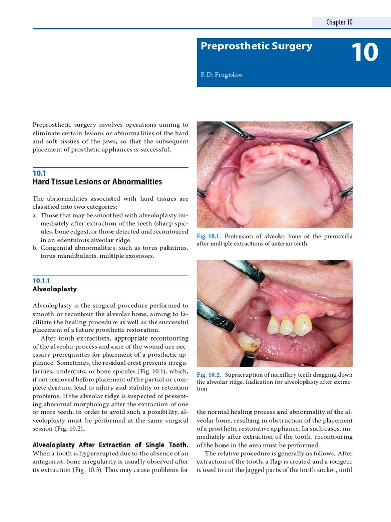 Fragiskos Preprosthetic Surgery. Oral Surgery, 243 279 | PDF | Medical Specialties | Mouth