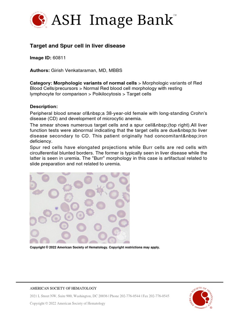 60811-Target and Spur Cell in Liver Disease | PDF