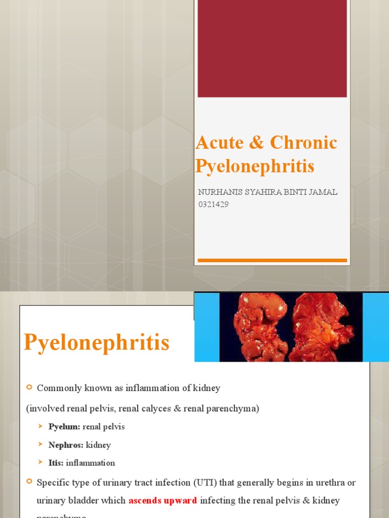 Acute & Chronic Pyelonephritis: Nurhanis Syahira Binti Jamal 0321429 ...