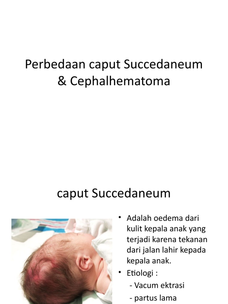 Perbedaan Caput Succedaneum - Cephalhematoma Kel 6 | PDF