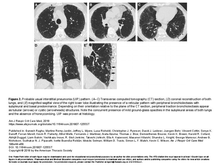 Figure 2. Probable Usual Interstitial Pneumonia (UIP) Pattern. (A-C ...