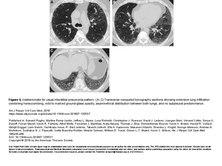Figure 4. Indeterminate For Usual Interstitial Pneumonia Pattern. (A-C ...