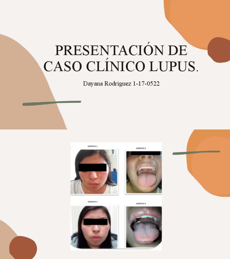 Presentación de Caso Clínico Lupus. | PDF