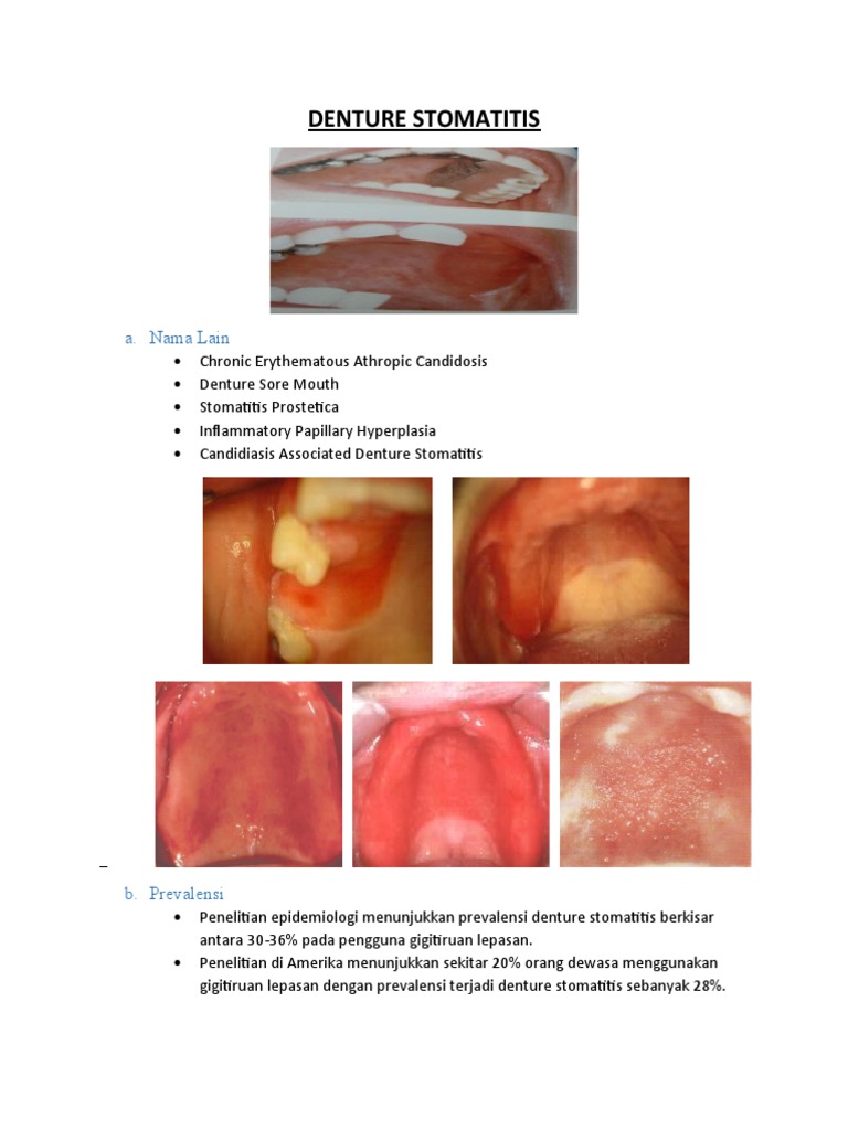 Klasifikasi dan Perawatan Denture Stomatitis | PDF | Kesehatan Holistik ...