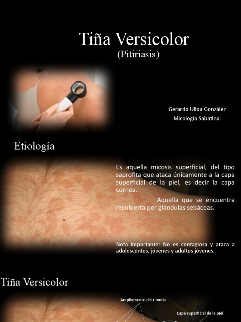 Tiña Versicolor Review | PDF | Medicina | Condiciones cutáneas