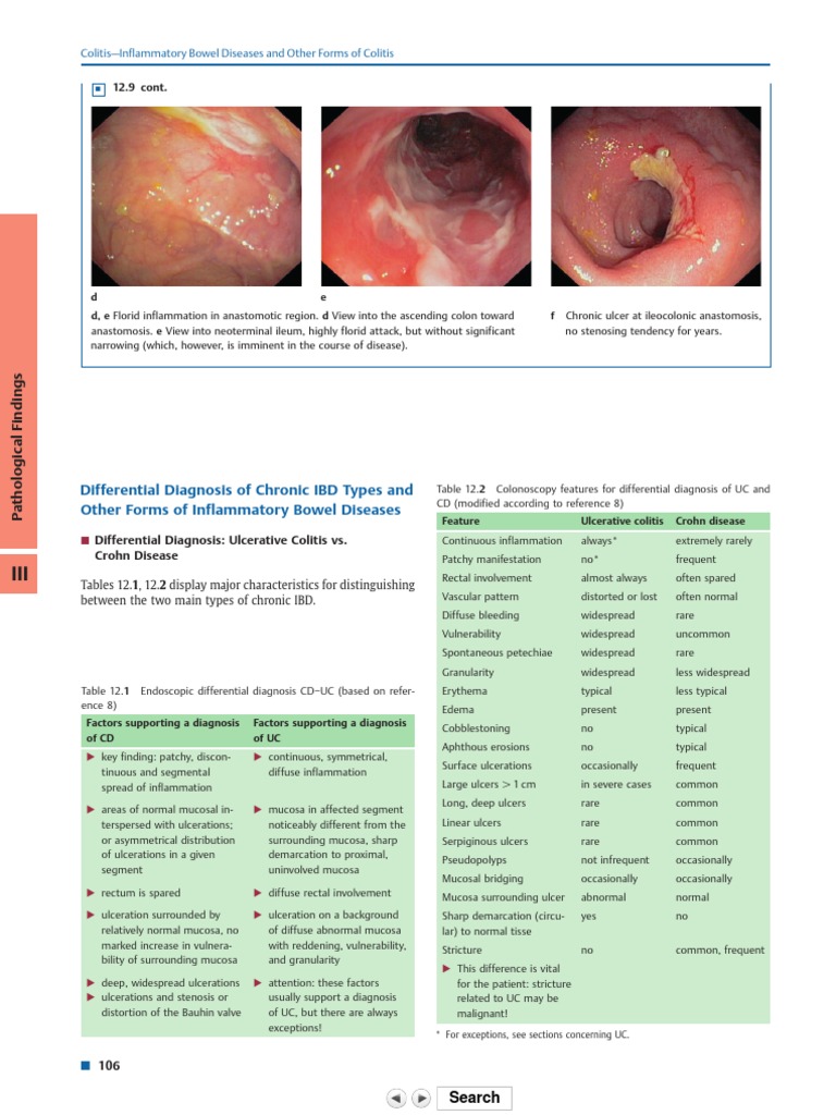 Differential Diagnosis of Chronic IBD Types and Ot | Inflammatory Bowel ...