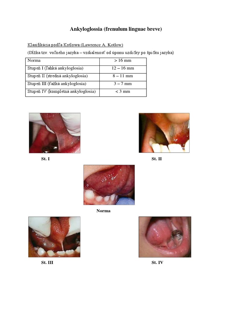 Ankyloglossia | PDF