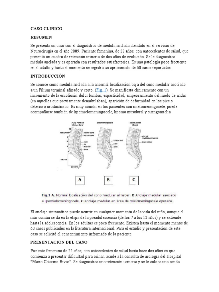 Caso de Médula Anclada en Adulto | PDF | Escoliosis | Médula espinal