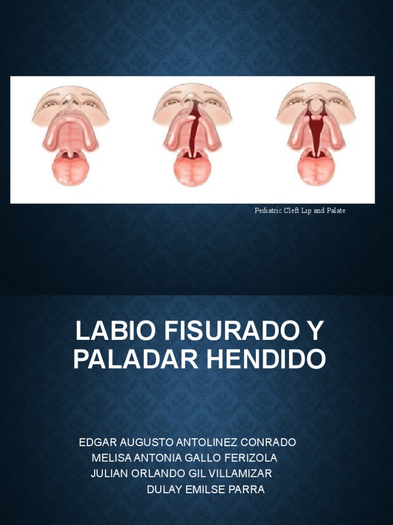 Labio Hendido y Paladar Hendido | PDF | Ortodoncia | Rasgos faciales