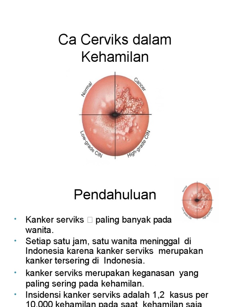 Ca Cerviks Pada Kehamilan | PDF | Pengembangan Diri | Sains & Matematika
