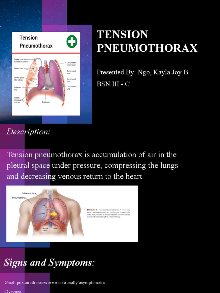 Understanding Tension Pneumothorax | PDF