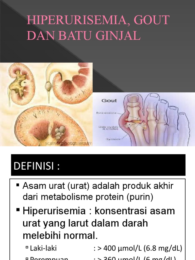 Hiperurisemia, Gout Dan Batu Ginjal | PDF