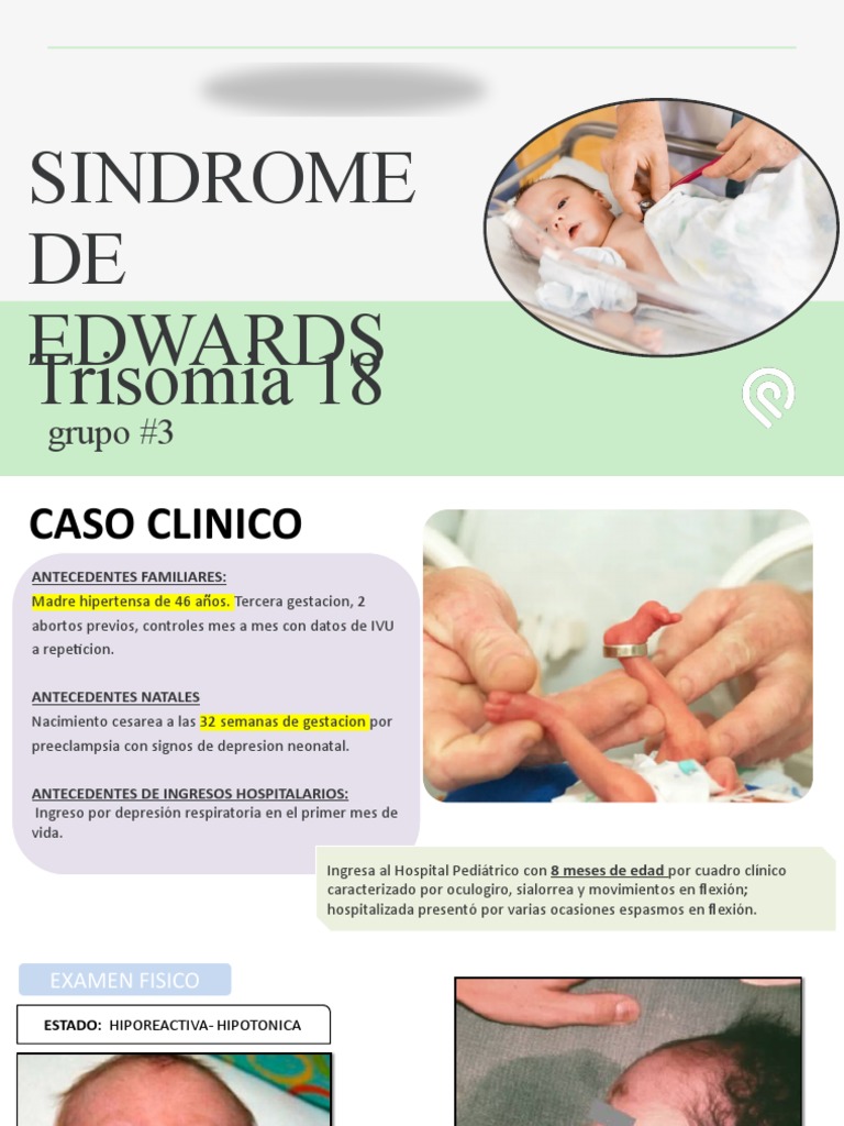 SINDROME DE EDWARDS Trisomia 18 | PDF | Especialidades Medicas ...