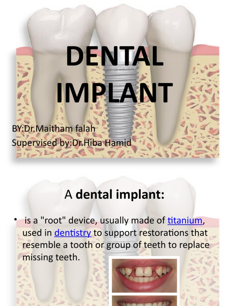 Vdocuments - MX Dental Implant 592632ae09497 | PDF | Dental Implant ...