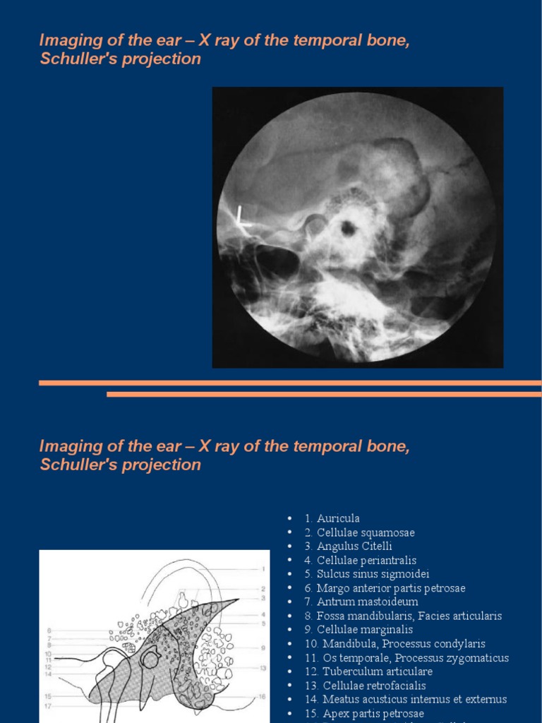 Imaging of The Ear - X Ray of The Temporal Bone, Schuller's Projection ...