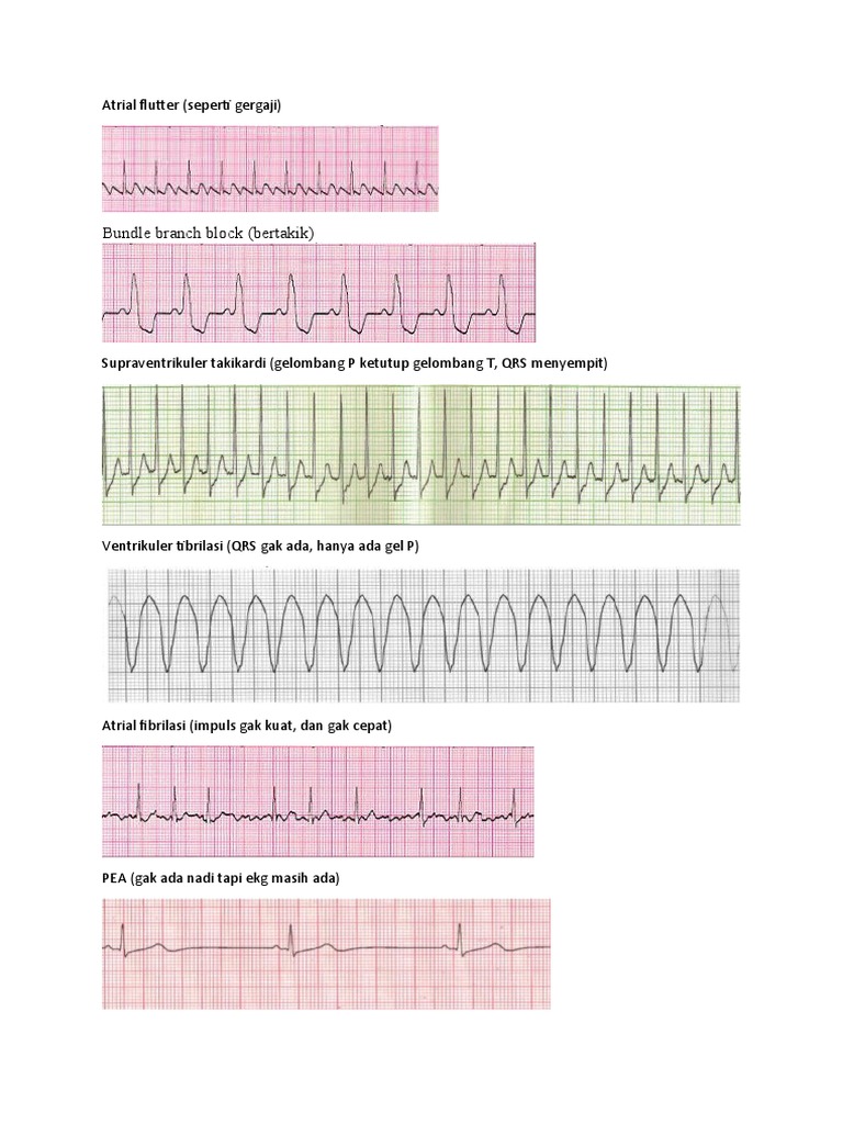 Jenis Irama Jantung dan EKG PEA | PDF