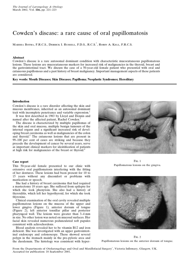 Cowden s Disease a Rare Cause of Oral sis 2002 Journal of Laryngology ...