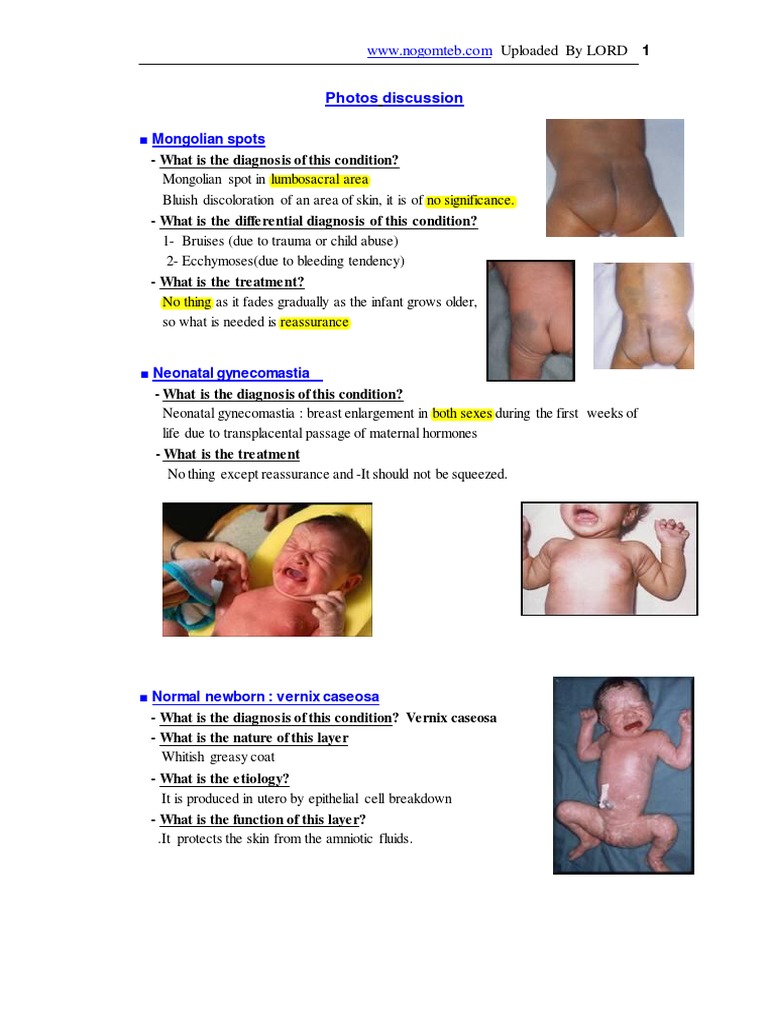 Mongolian Spots: Photos Discussion | PDF | Hypoglycemia | Candidiasis