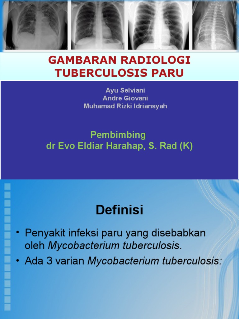 Radiologi TB Paru | PDF