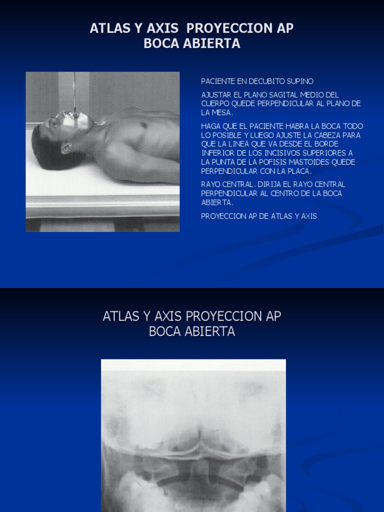 ATLAS Y AXIS PROYECCION AP RX | PDF | La columna vertebral | Vértebra