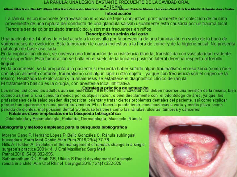 Ránula Oral en Niños: Caso y Tratamiento | PDF | Odontología ...
