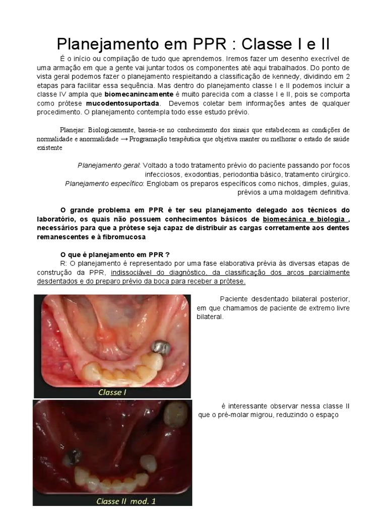 Planejamento em PPR - Classe I e II | PDF | Dente | Prótese