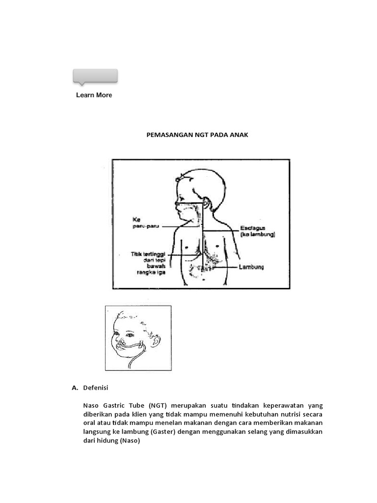 Pemasangan NGT Pada Anak | PDF