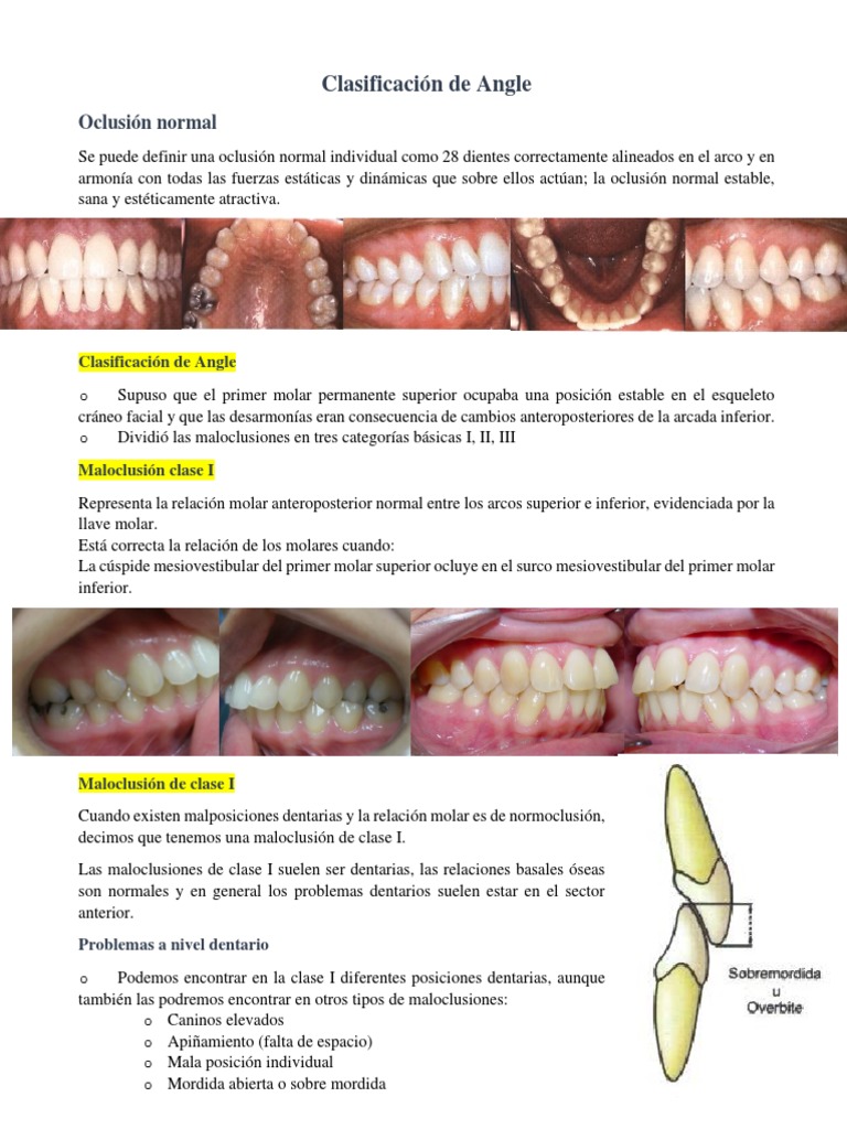 Clasificación de Angle | PDF | Boca | Diente