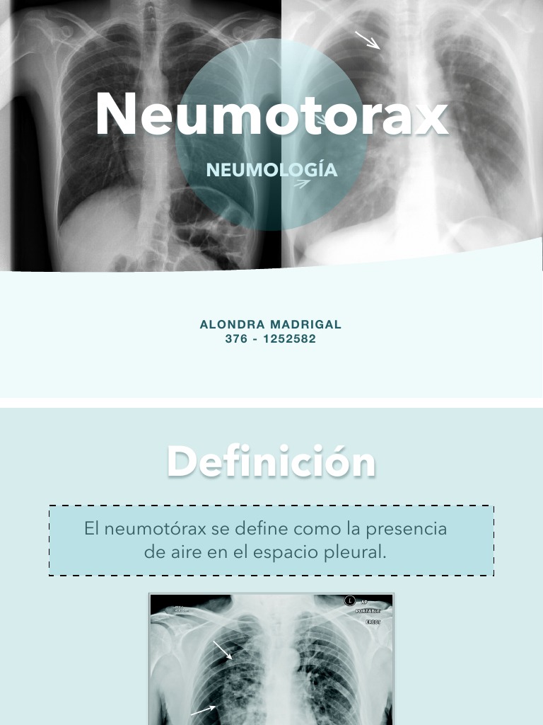 Neumotorax | PDF | Medicina CLINICA | Enfermedades y trastornos