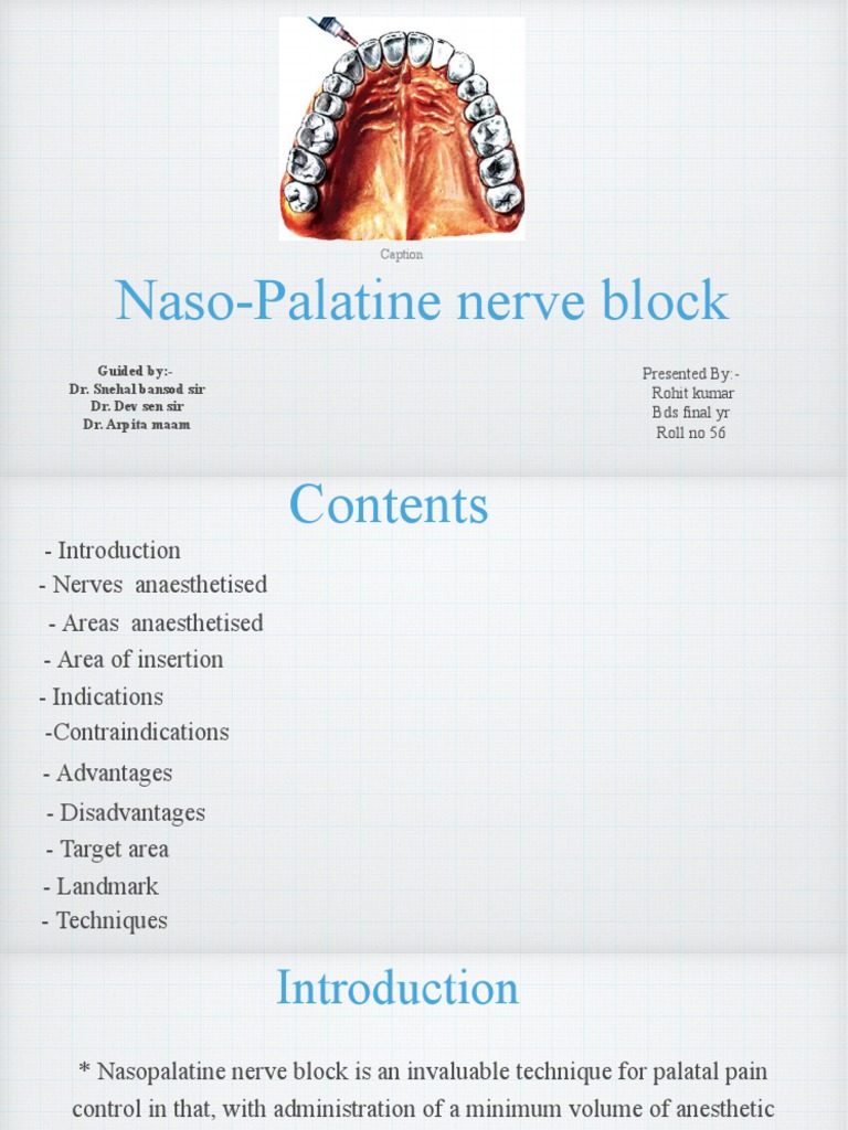 Nasopalatine Nerve Block | PDF | Injection (Medicine) | Anesthesia
