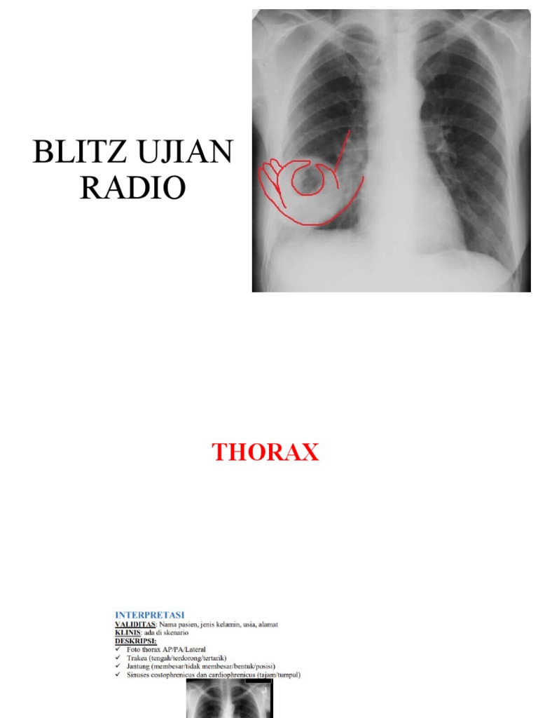 Sinus Costophrenicus dan Abses Paru | PDF