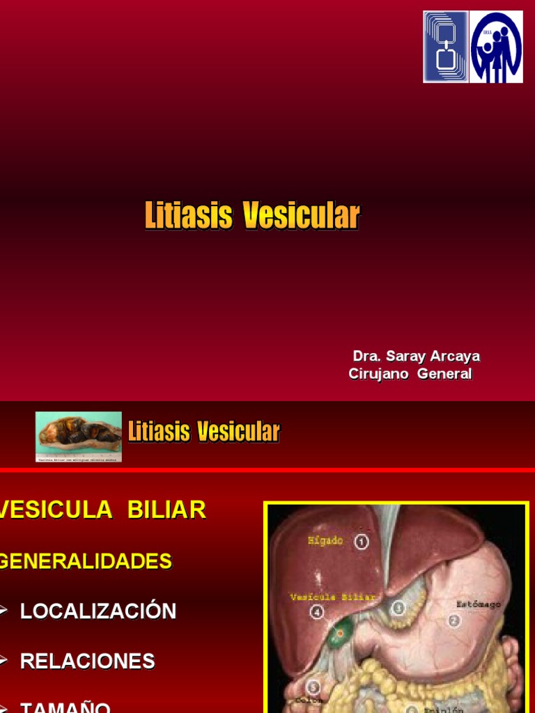 Litiasis Vesicular Version Final Clase | PDF | Medicina CLINICA ...
