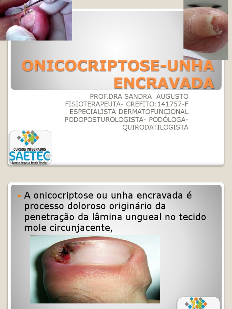 Aula 12 Onicocriptose Parte 1 | PDF | Dor | Inflamação