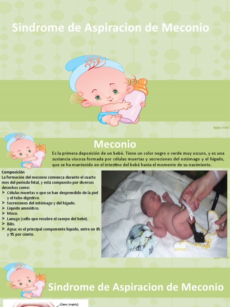 Síndrome de Aspiración de Meconio en Neonatos | PDF | El embarazo ...
