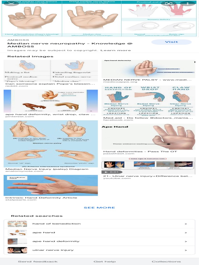benediction sign vs claw hand - Google Search | PDF