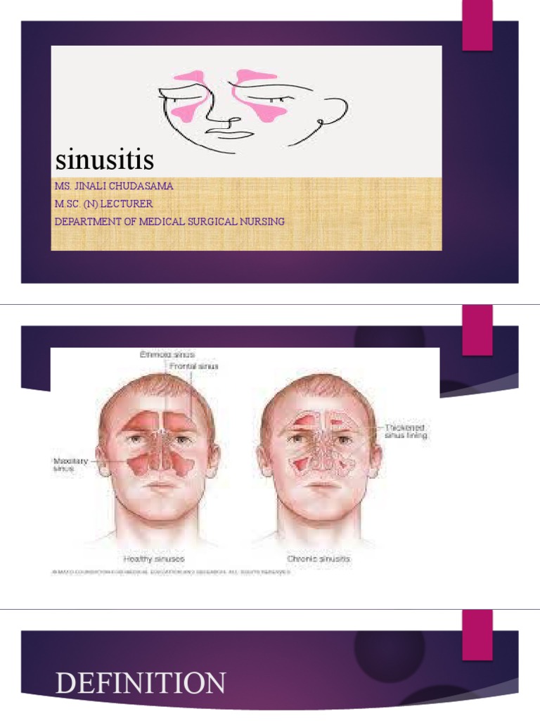 Sinusitis: Ms. Jinali Chudasama M.Sc. (N) Lecturer Department of ...