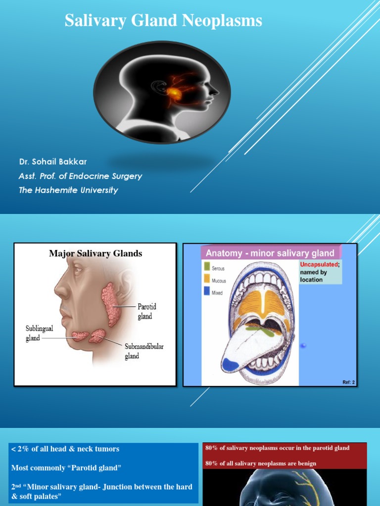 Salivary Gland Neoplasms: Dr. Sohail Bakkar | PDF