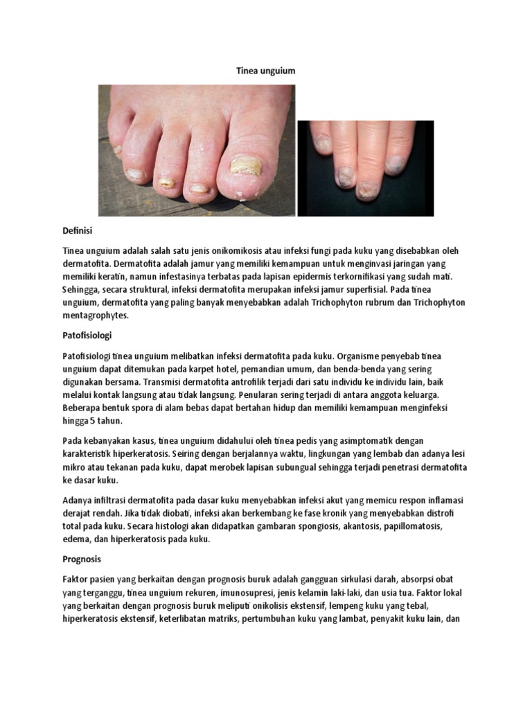 Tinea Unguiumfix | PDF