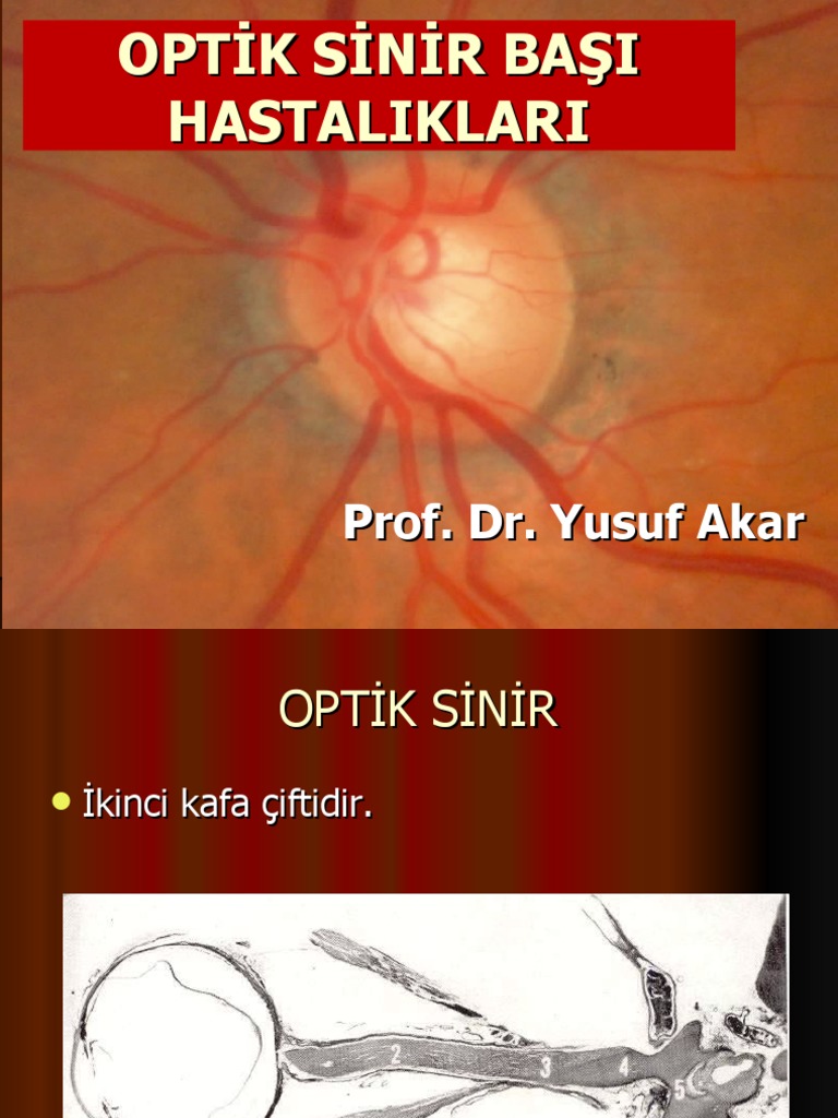 Opti̇k Si̇ni̇r Hastaliklari Yeni | PDF