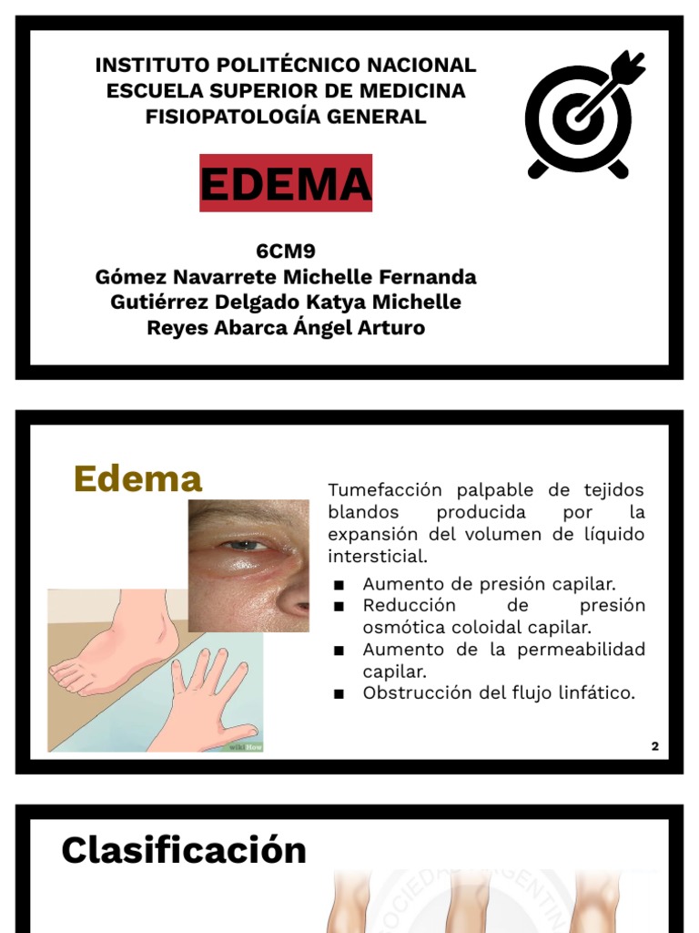 Clasificación y Fisiopatología del Edema | PDF | Edema | Especialidades ...
