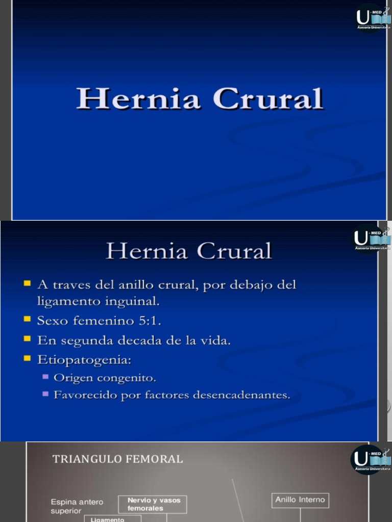 Hernia Crural | PDF