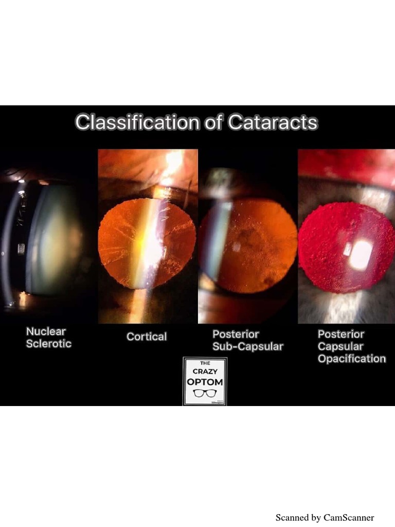 cataract | PDF